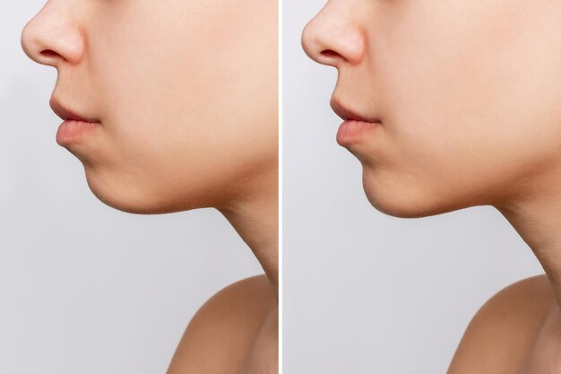Say Goodbye to Double Chins: Non-Surgical Reduction Techniques